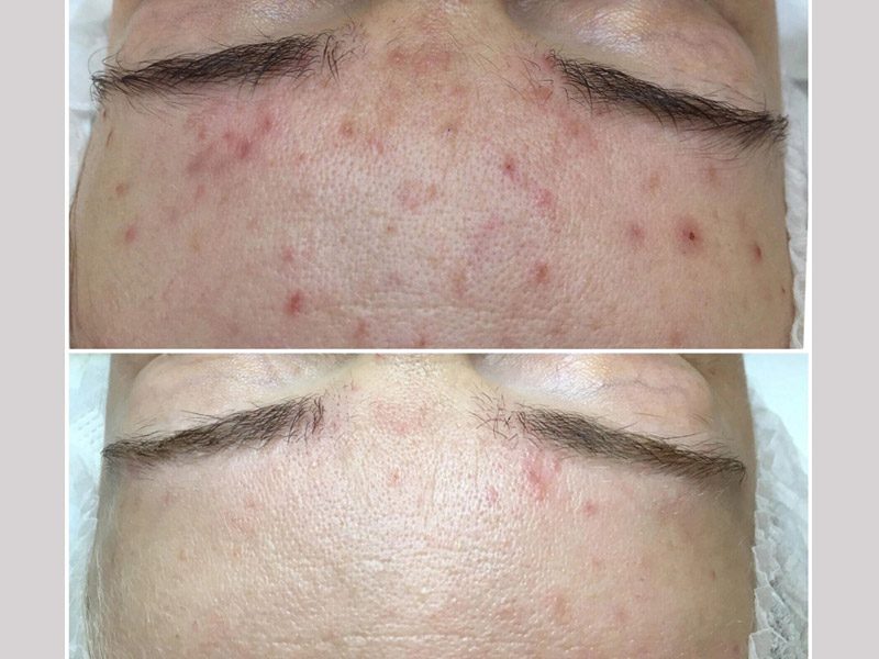 Oczyszczanie twarzy trądzikowej – zobacz jak to robimy - HealthyBeauty